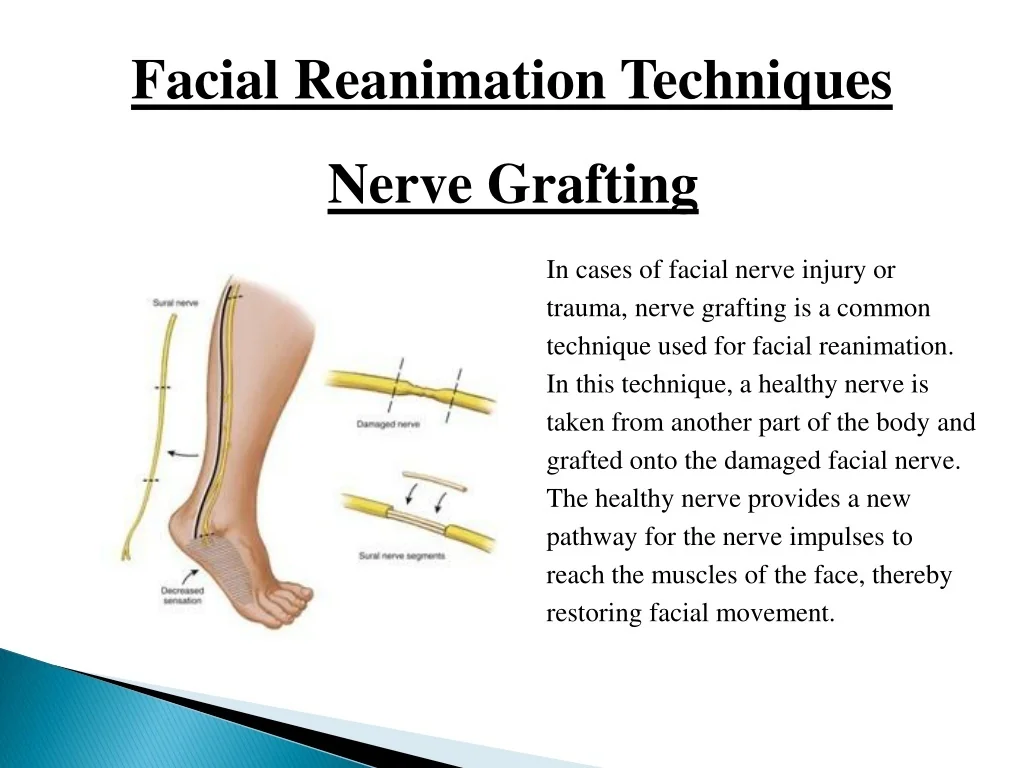 PPT - Leading Clinic For Facial Paralysis Treatment in Mumbai ...