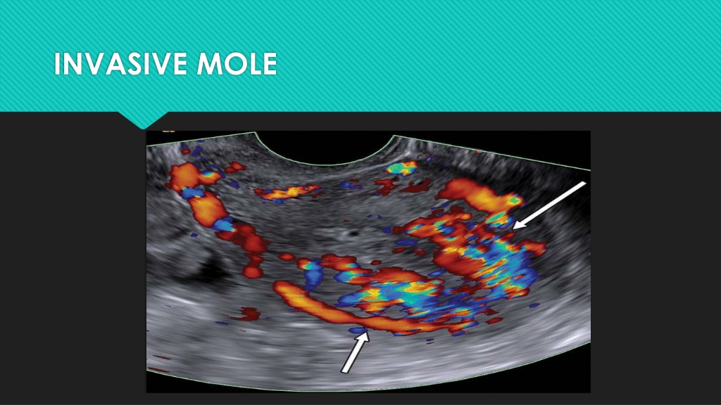 Ppt Transvaginal Ultrasound Powerpoint Presentation Free Download