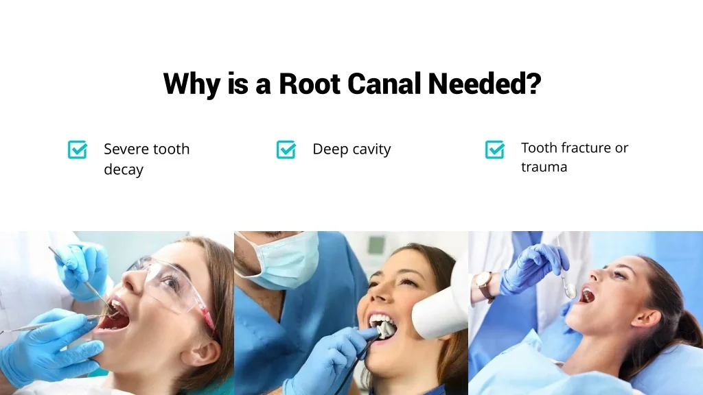 PPT - Root Canal Treatment PowerPoint Presentation, free download - ID ...