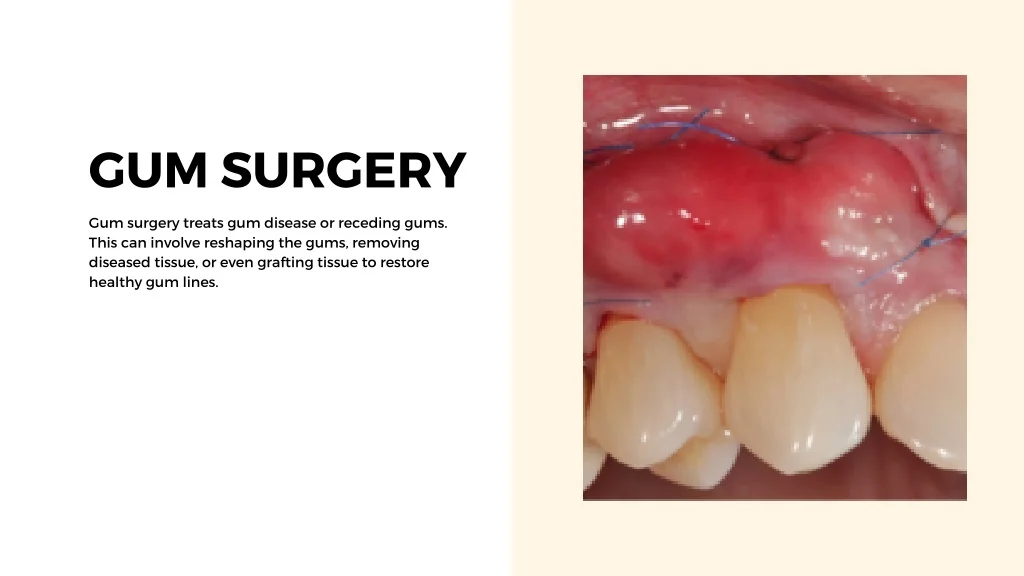 PPT - Most Common Types of Dental Surgery PowerPoint Presentation, free ...